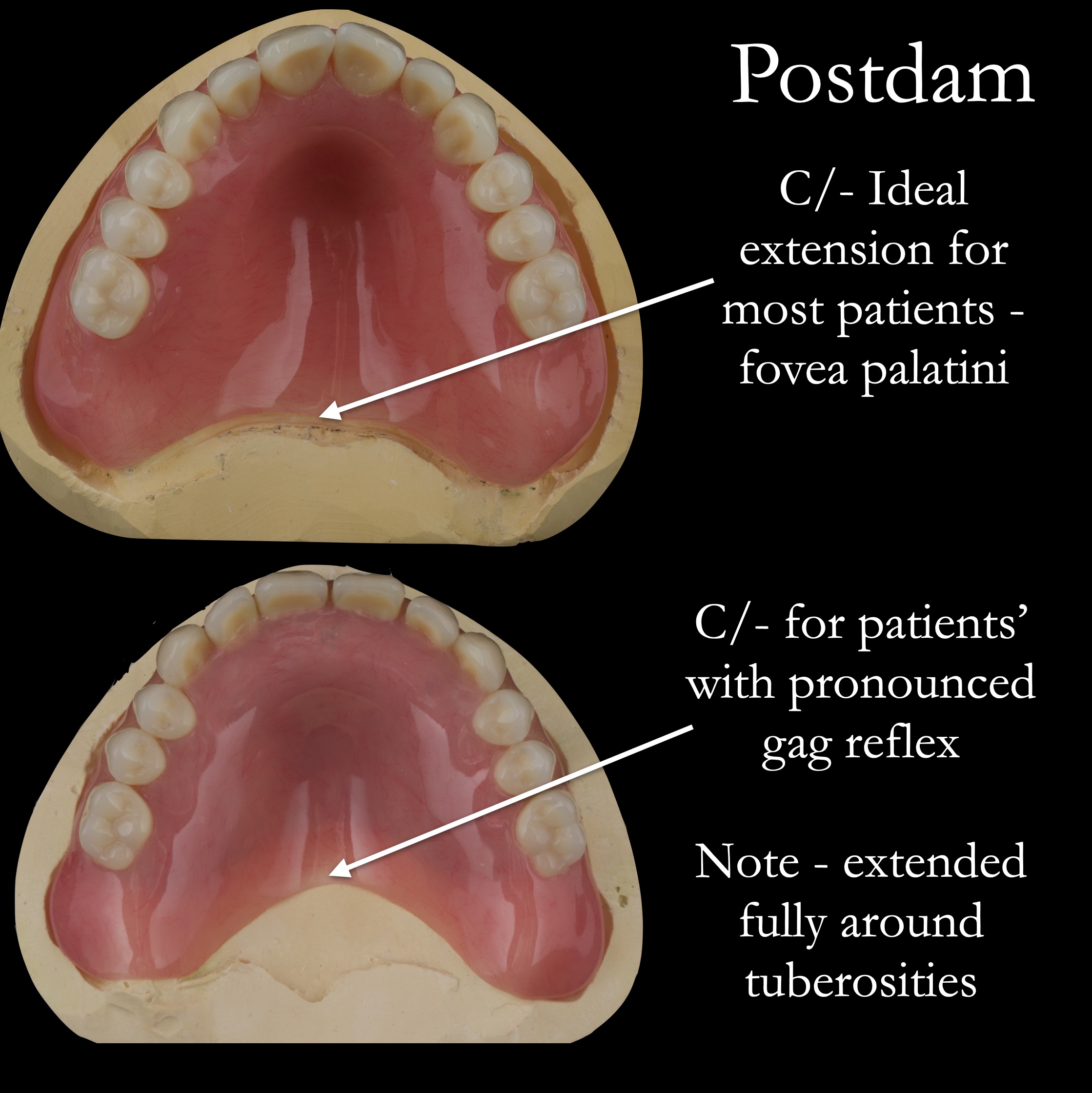 Palatal Extension Gag Reflex Finlay Sutton Denture Education