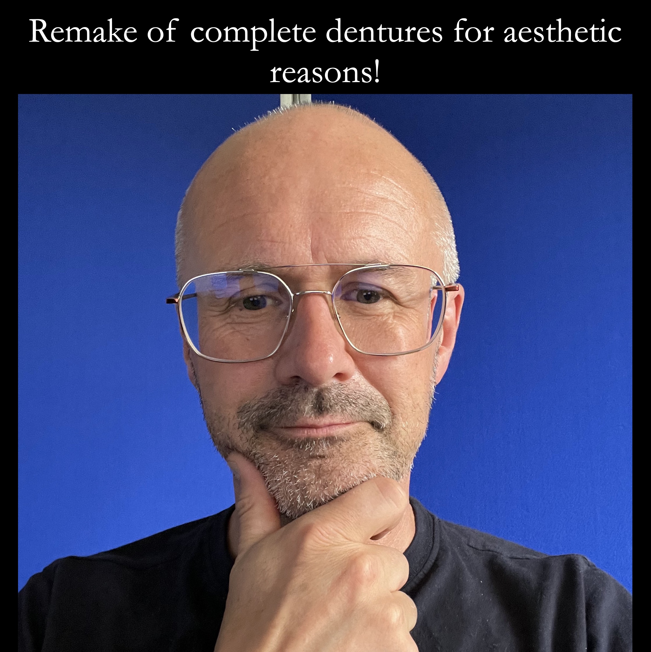Remake for aesthetic reasons | Finlay Sutton - Denture Education