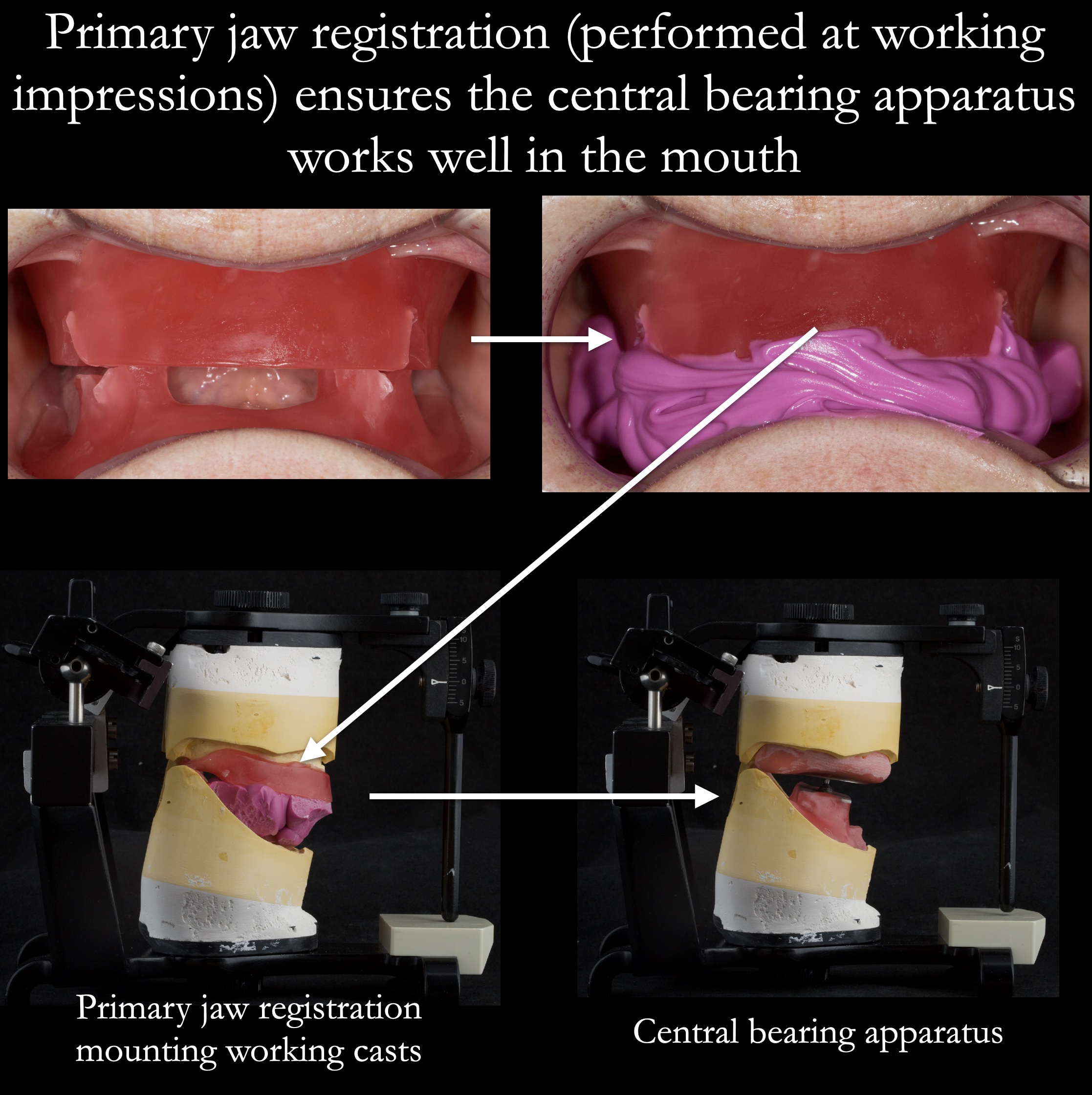 Getting the plates parallel on the gothic arch tracing | Finlay Sutton ...