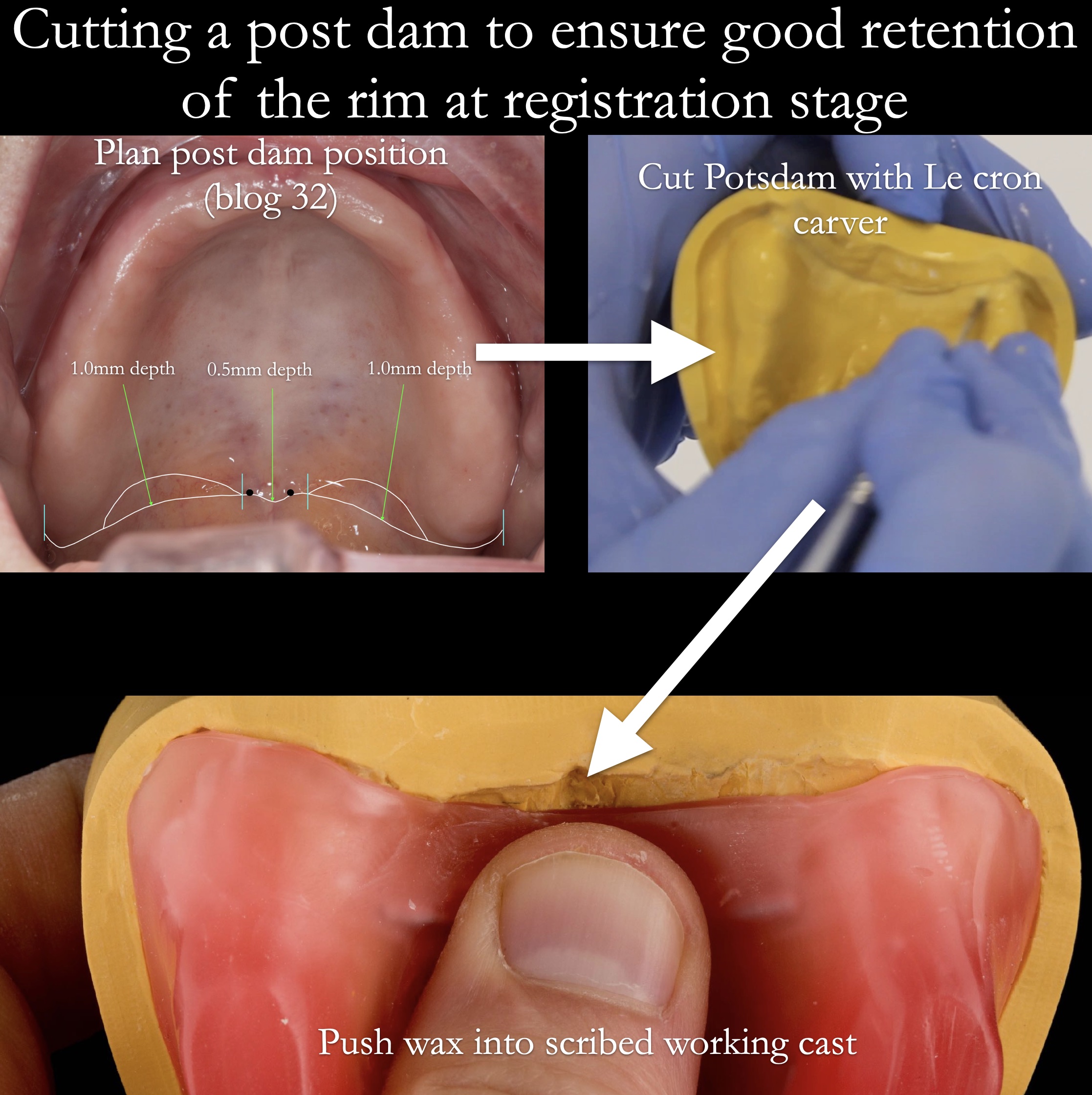 Good retention of the upper wax rim helps assess the aesthetics ...