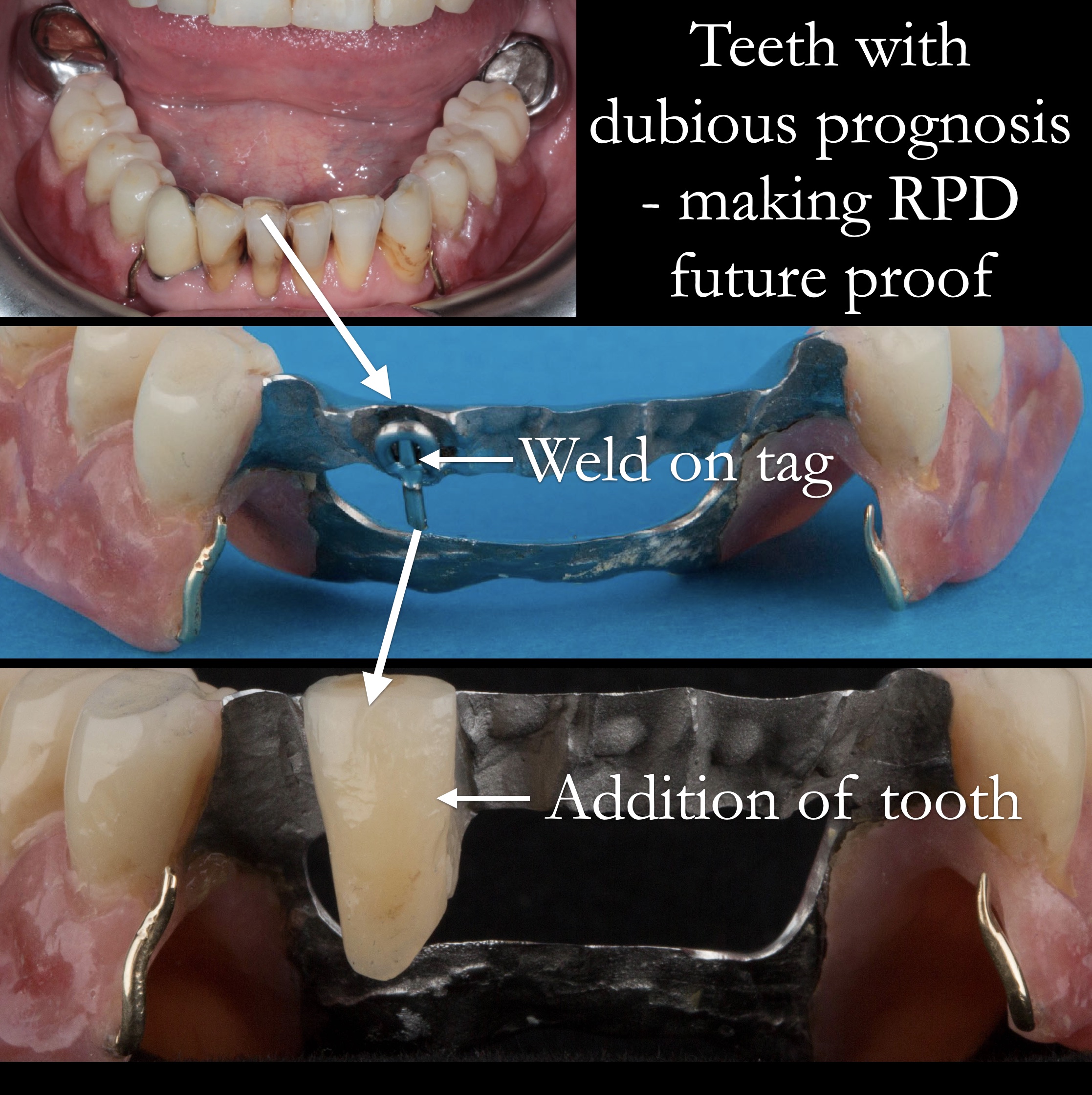 Partial dentures – dubious prognosis abutment teeth | Finlay Sutton ...