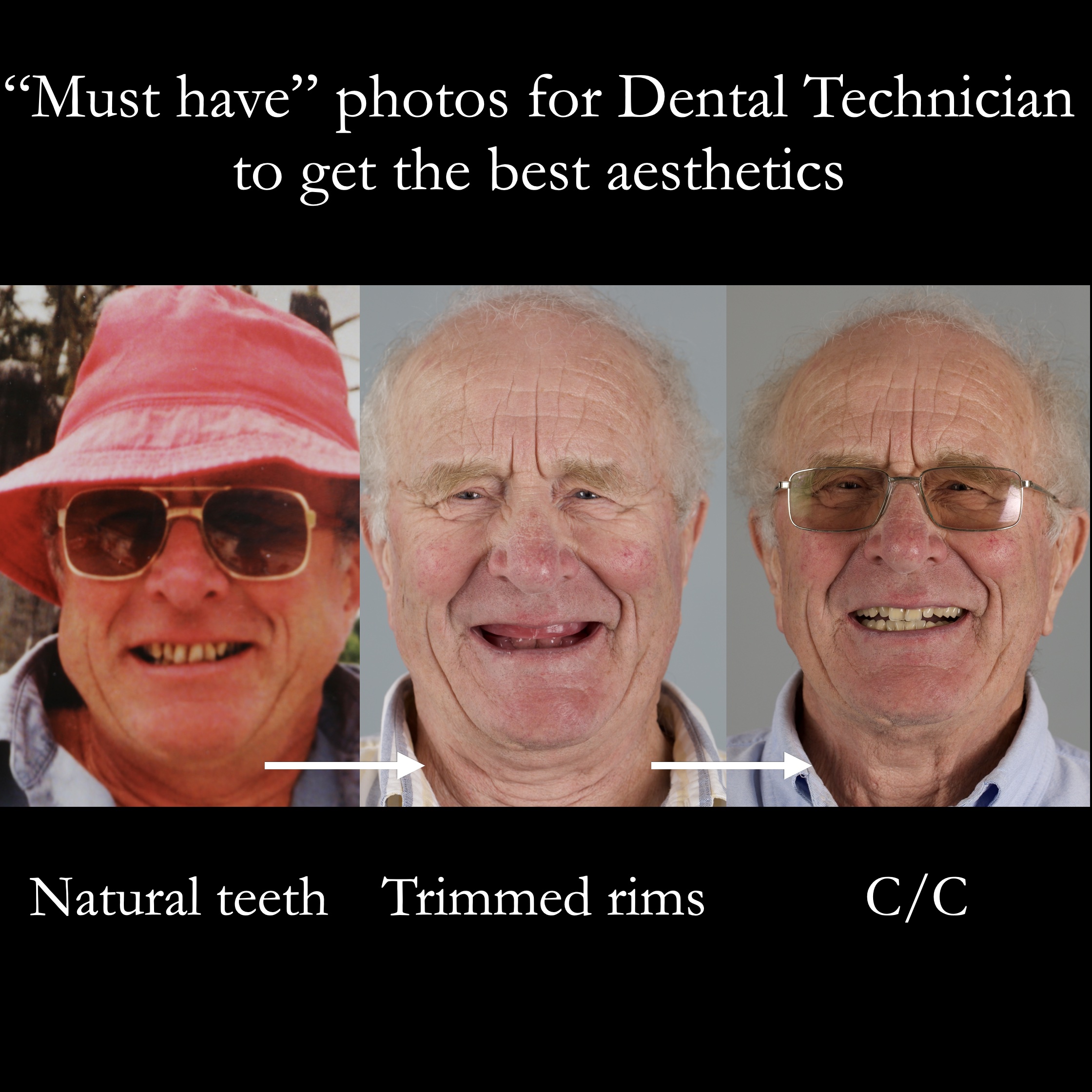 Photographs of the patient smiling with the shaped wax rims in situ ...