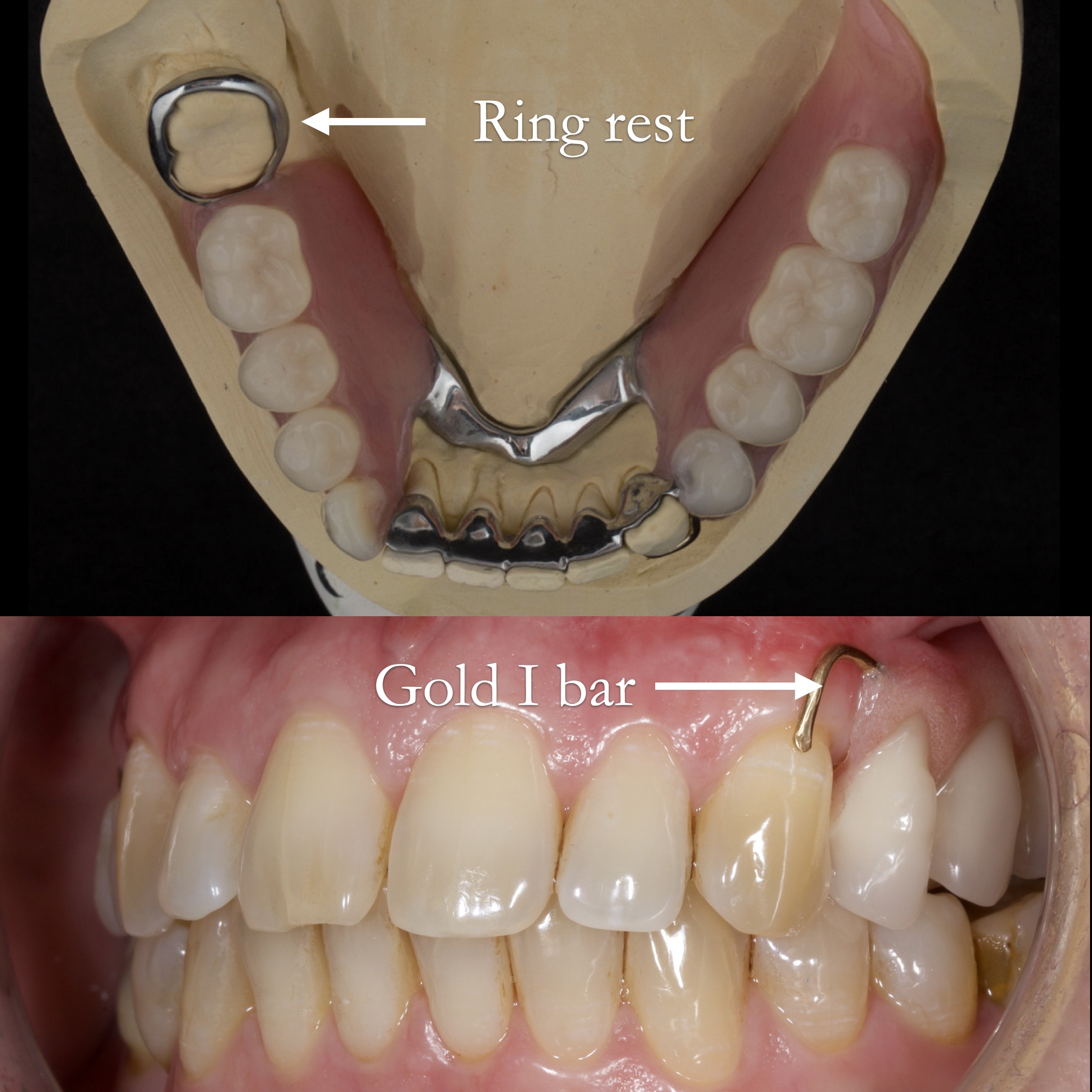 Ring rests and gold clasps | Finlay Sutton - Denture Education