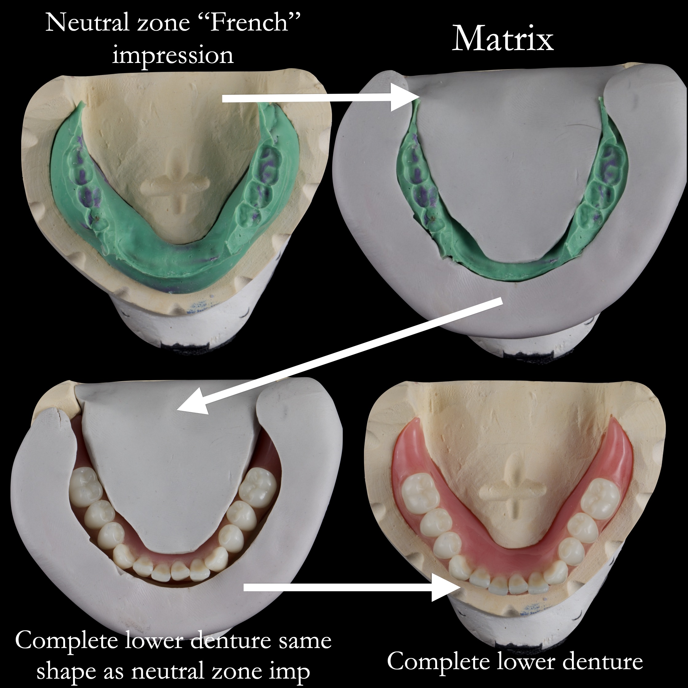 Madeline's new complete dentures | Finlay Sutton - Denture Education